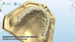 Premium Implant Bar and Locator Attachment Solution