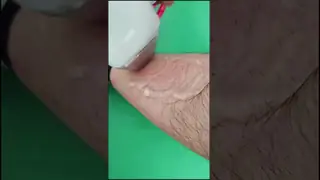Ultimate Vertical Diode Laser Hair Removal System