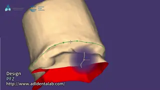 PFZ Dental Crowns Natural Strength and Precision Fit