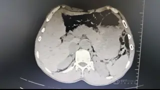 CT at 1-Month Follow-Up