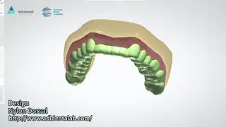 Stop Teeth Grinding With Custom Nylon Dorsal Night Guards