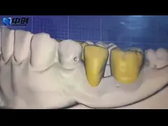 치아 빛 치료 3D 프린팅 고 정밀도 고 강도 레진 오렌지