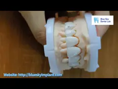 highly translucent zirconia with customized jewelry and gold beautiful dental restoration case