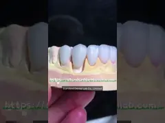 high esthetic teeth emax laminate veneers incisal translucency