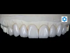 customization dental lab laminate veneers with high stain resistance and strength