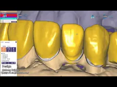 hybrid pink porcelain implant crown malong full arch implant bridge immediate loading