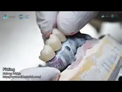 합성 분홍색 포르셀라인 크라운 A1 Shade All On 4 하이브리드 티타늄 나사 유지