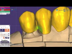 Durable Hypoallergenic EMAX Bridge Extreme Esthetics Emax Dental Bridge