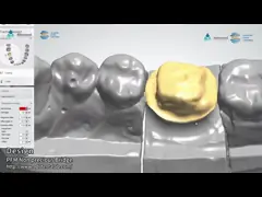 natural tooth color ceramic feldspathic veneer for anterior and posterior teeth