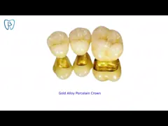 Customized PFM Porcelain Dental Crown Full Metal Corrosion Resistance