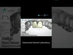 natural pressed emax veneer strength 16 shades emax teeth veneers