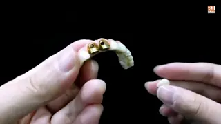 maloney zirconia bridge implant bar for dental restoration custom no foreign body sensation