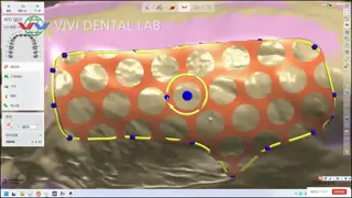 skelete chrome metal partial denture printed cocr denture design
