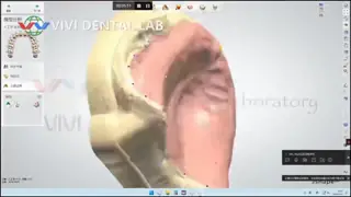 milled acrylic denture china dental lab