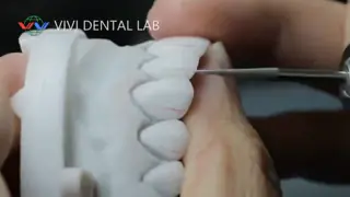 tranlucent emax laminate veneers / porcelain dental veneers iso approved